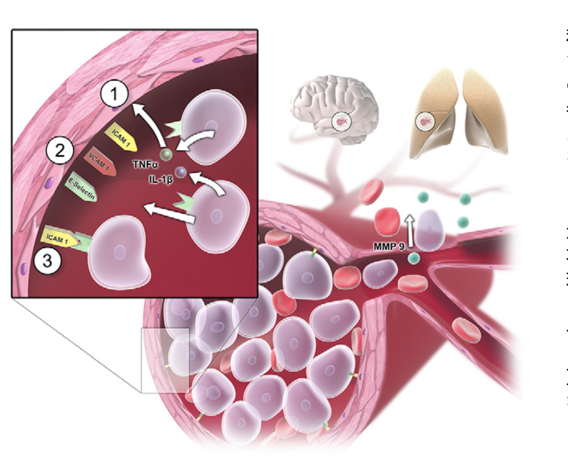 ICU備忘録 : Leukostasis