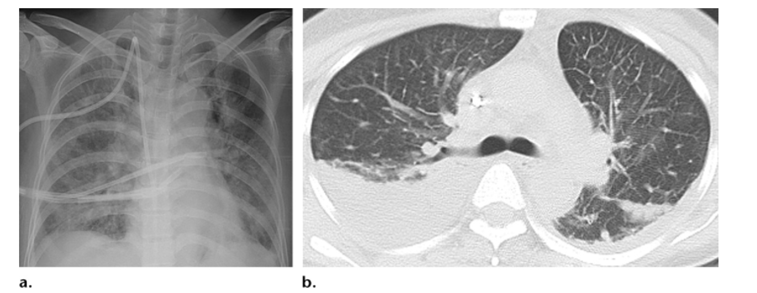 ICU備忘録 : Leukostasis