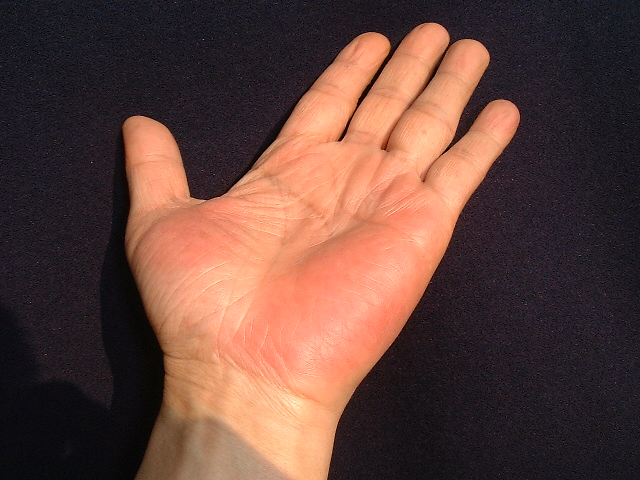 私の手掌紅斑について:C型肝炎の完治をめざして
