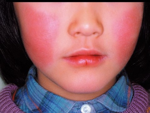 リンゴ病は学校伝染病から外れてるのね！！/大人では、多関節痛や貧血に！！ : clazycatのblog