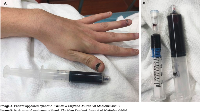 医学部の勉強 分子病理学 : Methemoglobinemia メトヘモグロビン血症
