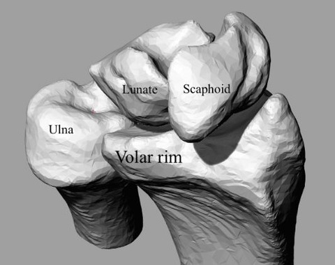 整形外科医のブログ : 橈骨のRim Fractureの手術治療