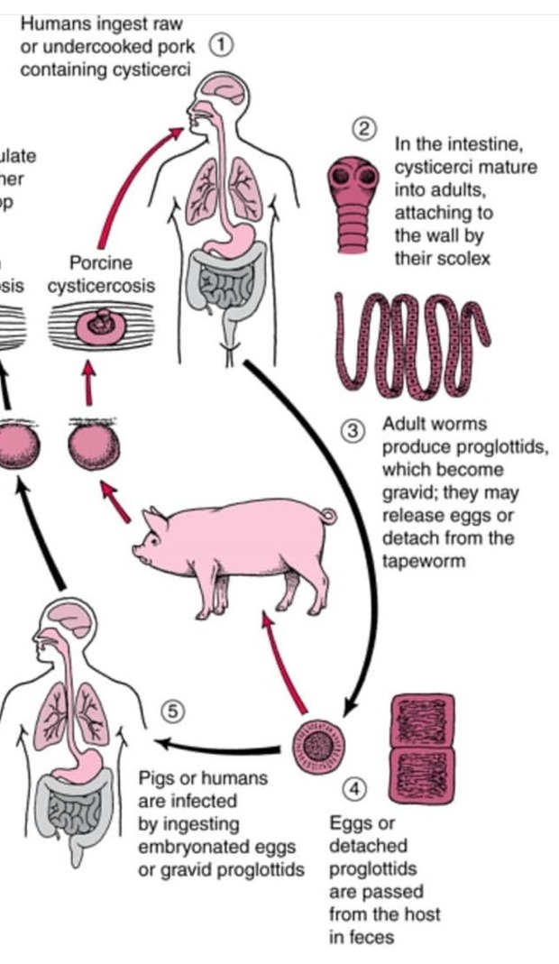 生焼けの豚肉を食べて寄生虫に感染、米研究者が患者のct写真を公開して注意喚起 Usagineko5bai 2nd 7462