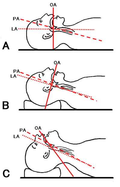 Q：スニッフィング・ポジション（sniffing position）とは？ : 麻酔科勤務医のお勉強日記