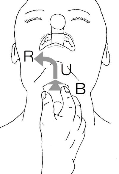 Q：挿管介助の BURP 法とは何か？ : 麻酔科勤務医のお勉強日記