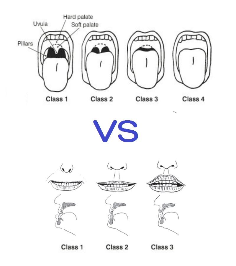 パキスタンの三次医療病院での挿管困難予測における Mallampati 試験と上口唇咬合試験の比較 : 麻酔科勤務医のお勉強日記