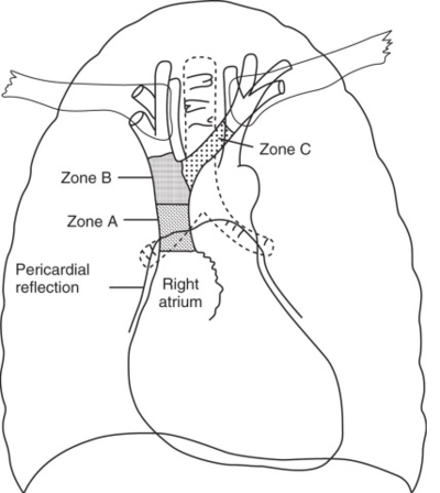 Q：CV カテーテルの先端はどこに位置させるのがよいか？ : 麻酔科勤務医のお勉強日記