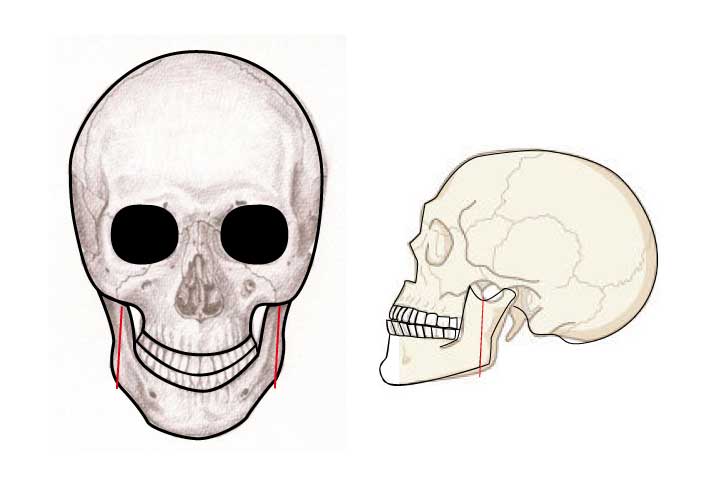 受け口（顎変形症）手術 歯科矯正 にお悩みの方へ : IVRO（下顎枝垂直骨切り術）