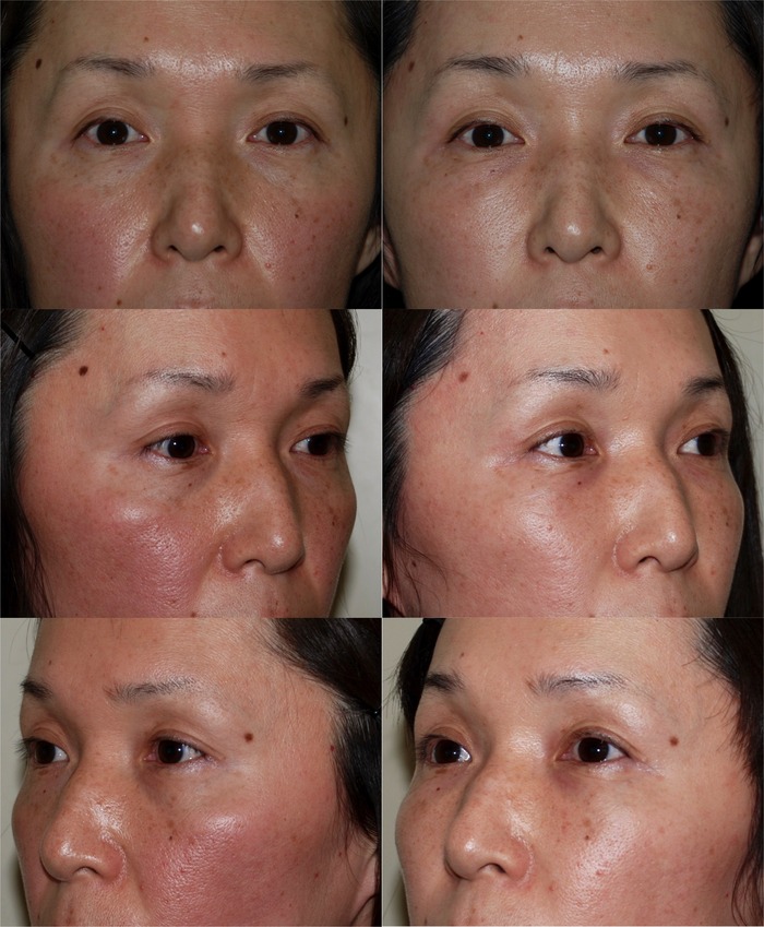 PRPF（PRP＋bFGF)療法のパーツモニターさま 治療後4ヶ月 - 美容形成外科医Dr 牧野のblog