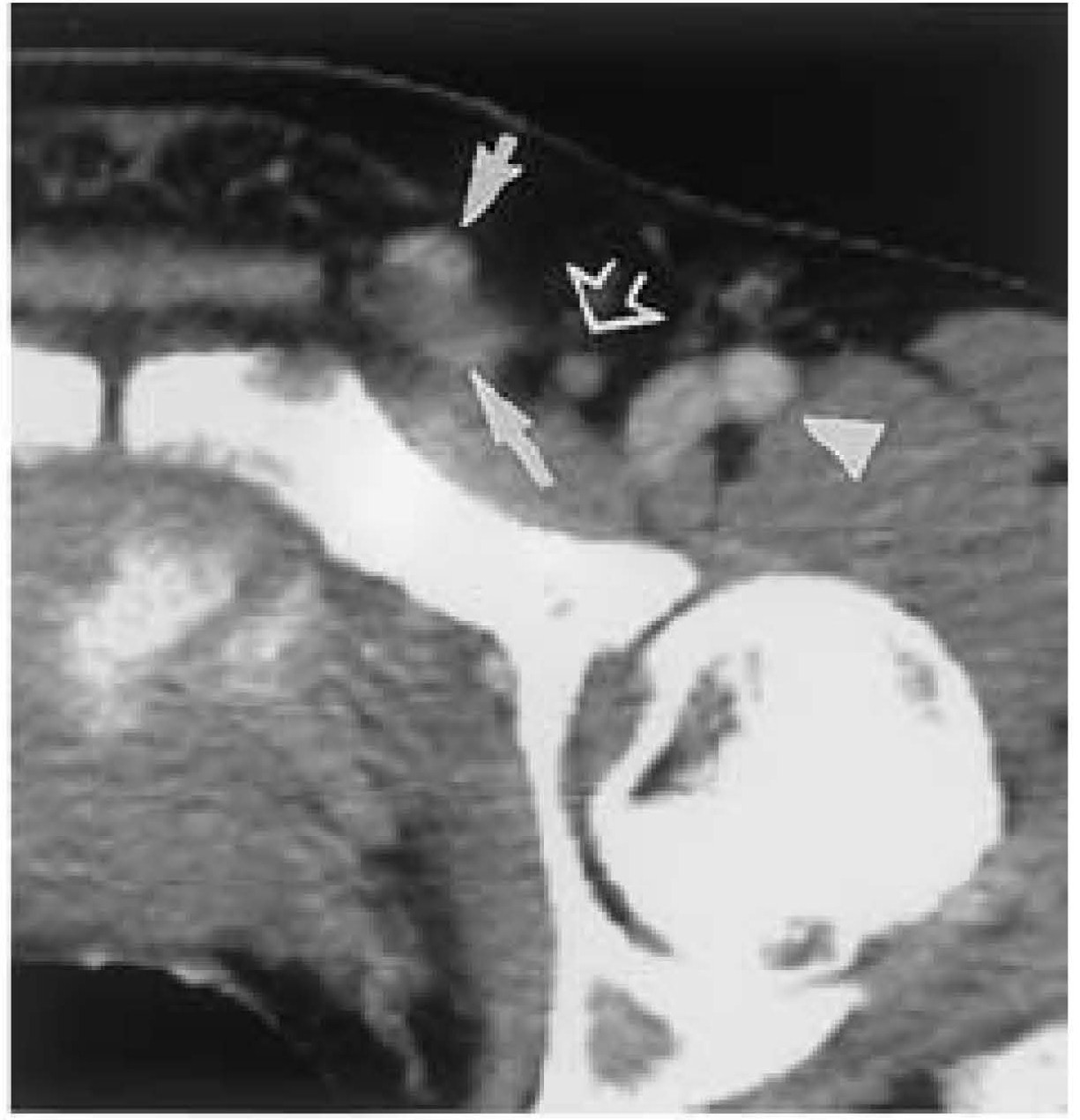 米国臨床医学留学（骨髄移植）ブログ:Node of Cloquet