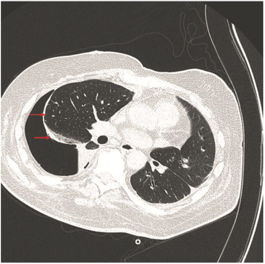 Trapped lungとLung entrapmentの違い : 今日なに読もう〜病院総合診療医の論文ブログ〜