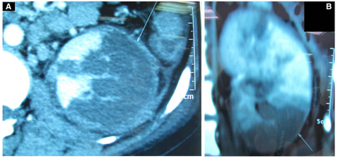 Cortical rim signとReverse rim sign : 今日なに読もう〜病院総合診療医の論文ブログ〜