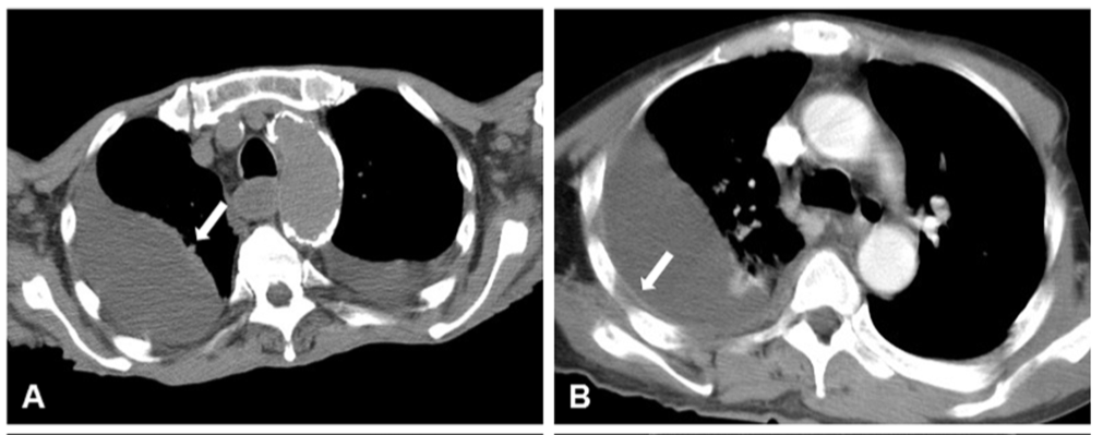 膿胸/複雑性胸水のSpilit pleura sign : 今日なに読もう〜病院総合診療医の論文ブログ〜