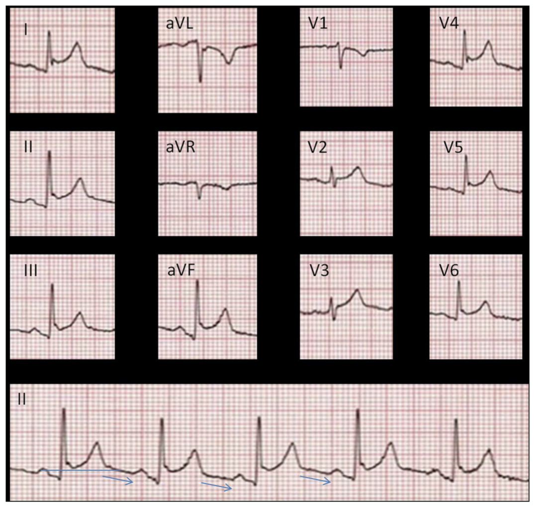急性心膜炎のPR低下とSpodick’s Sign : 今日なに読もう〜病院総合診療医の論文ブログ〜