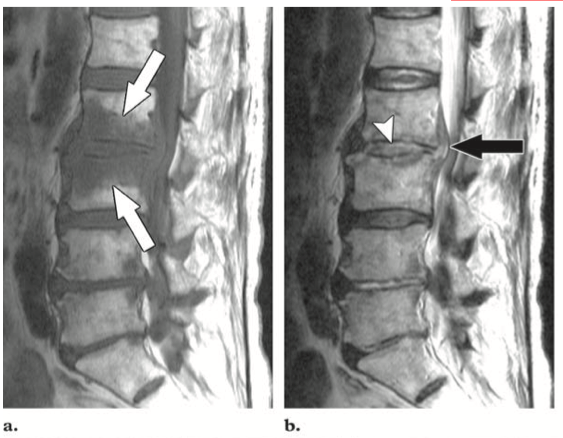 mri 骨転移 – 骨転移 レントゲンでわかる – BREQ