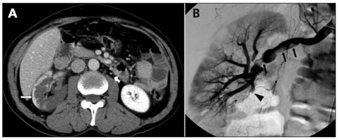 Cortical rim signとReverse rim sign : 今日なに読もう〜病院総合診療医の論文ブログ〜