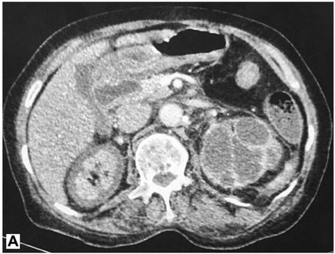 Cortical rim signとReverse rim sign : 今日なに読もう〜病院総合診療医の論文ブログ〜