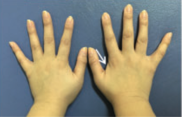 18歳女性 右手の筋力低下 : 今日なに読もう〜病院総合診療医の論文ブログ〜