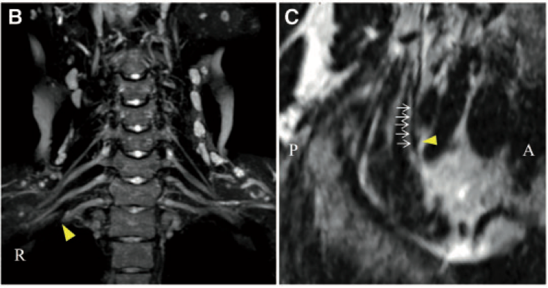 18歳女性 右手の筋力低下 : 今日なに読もう〜病院総合診療医の論文ブログ〜