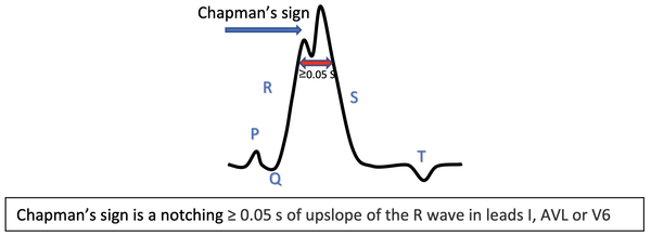 Chapman's signについて : 今日なに読もう〜病院総合診療医の論文ブログ〜