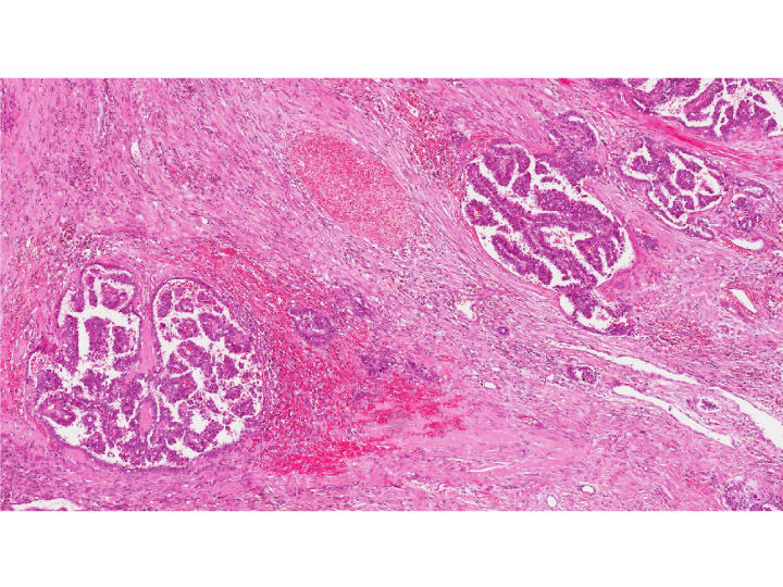南に吹く風 : SGH Breast Pathology Course 2012 (2)