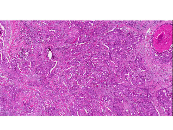 南に吹く風 : SGH Breast Pathology Course 2012 (2)
