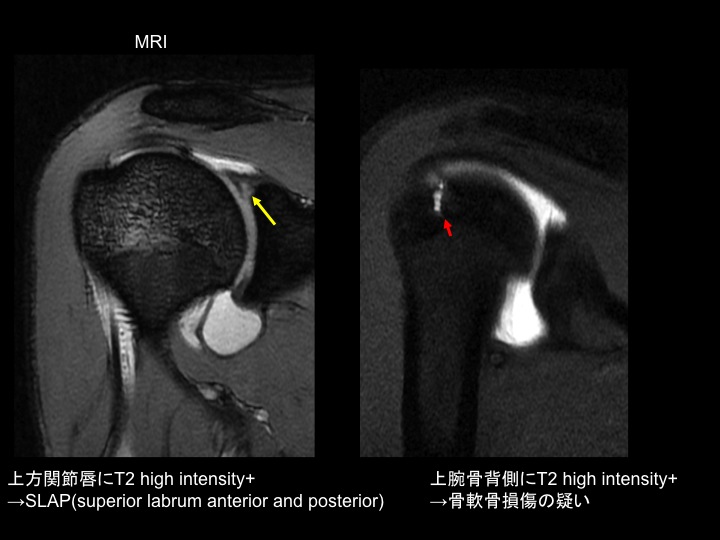保存療法で治らない肩のBennett Lesionを関節鏡視下に治療する。 : スポーツ整形外科医S. Uのブログ Sports ...