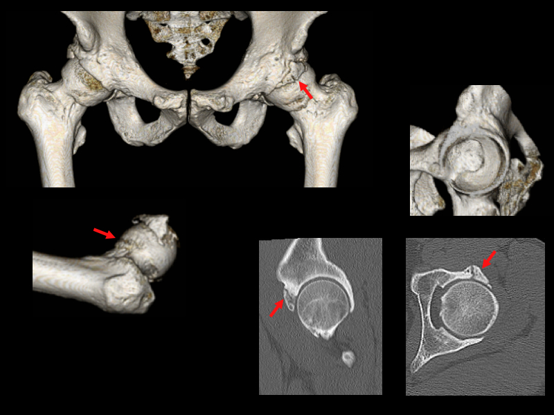 2010年最難関手術 ベスト1 巨大os acetabuli を撃破し、関節唇を生き返らせる 鏡視下股関節唇再建術 : スポーツ整形外科医S ...