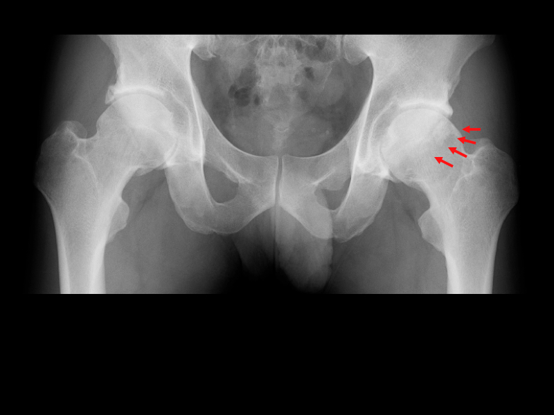 2010年最難関手術 ベスト1 巨大os acetabuli を撃破し、関節唇を生き返らせる 鏡視下股関節唇再建術 : スポーツ整形外科医S ...