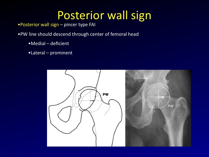 股関節インピンジメント（FAI femoral acetabular impingement）の典型的な単純レントゲン所見 PINCER編 ...