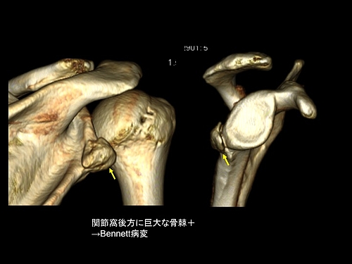 保存療法で治らない肩のBennett Lesionを関節鏡視下に治療する。 : スポーツ整形外科医S. Uのブログ Sports ...