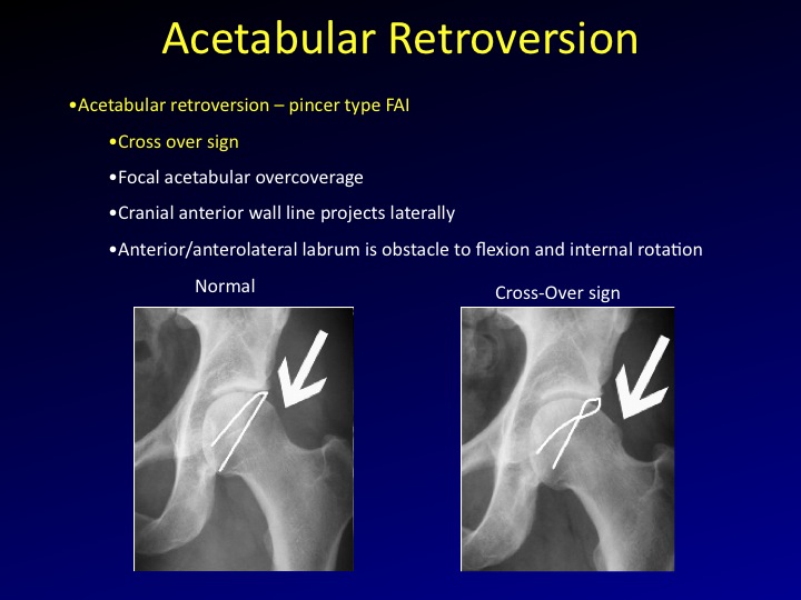 股関節インピンジメント（FAI femoral acetabular impingement）の典型的な単純レントゲン所見 PINCER編 ...