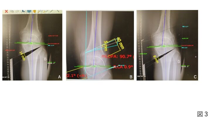 ダブルレベルオステオトミー Dr. SUの治療体験記 : スポーツ整形外科医S. Uのブログ Sports Physician S.U Blog