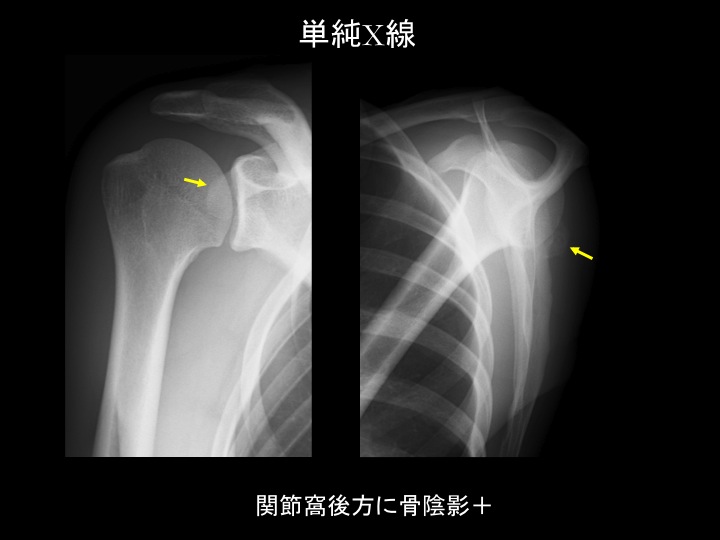 保存療法で治らない肩のBennett Lesionを関節鏡視下に治療する。 : スポーツ整形外科医S. Uのブログ Sports ...
