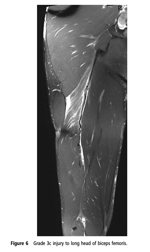 BAMIC Classification : 若手スポーツ整形外科医の自主勉ブログ/成長日記