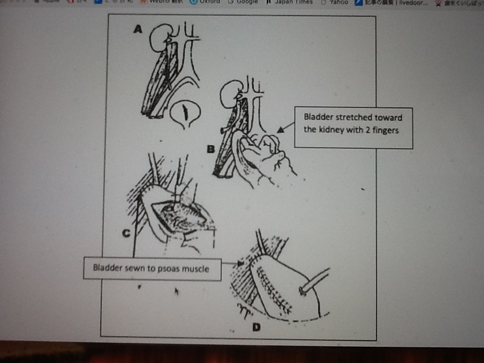 reconstruction of ureter 尿管再建手術(Columbia University Irving Medical ...