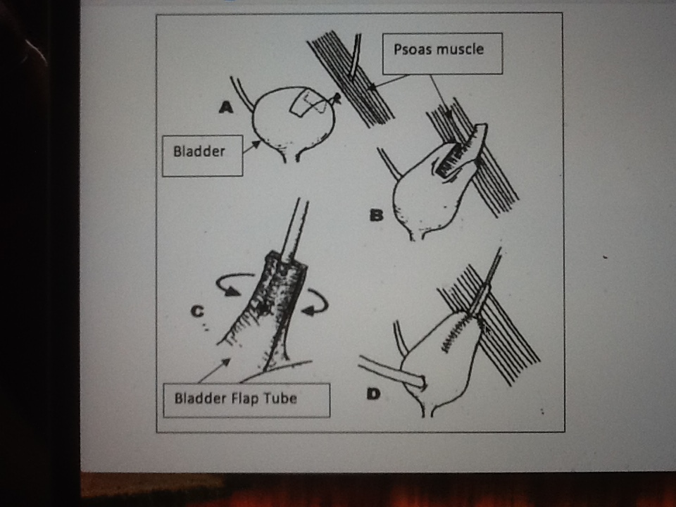 reconstruction of ureter 尿管再建手術(Columbia University Irving Medical ...