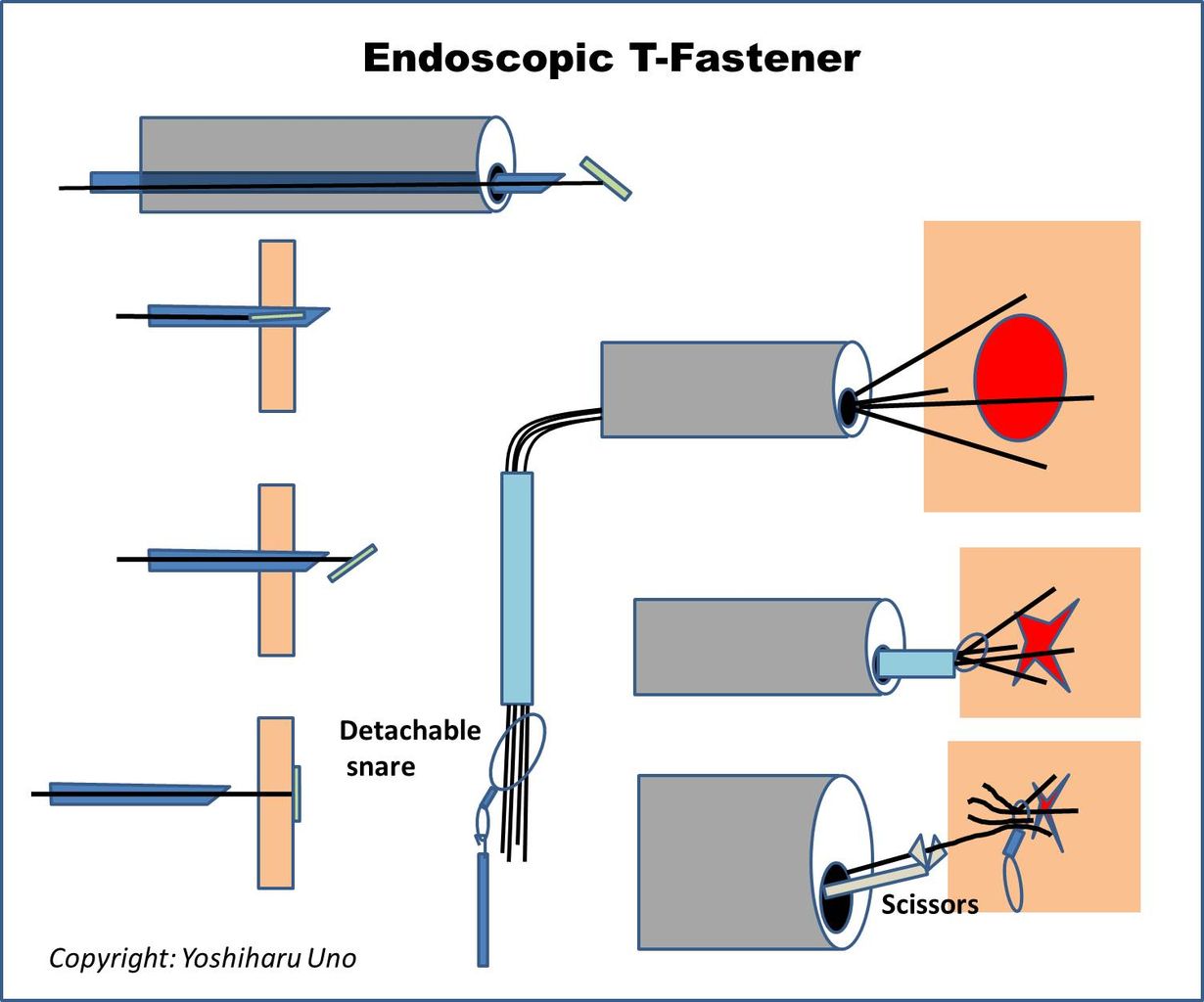 Endoscopic T-fastener: Endoscopic Clip and Endoscopic Suture : 宇野コラム ...